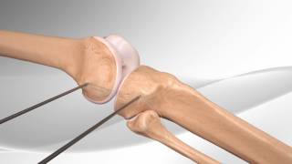 Ligament Reconstruction Weatherford | ACL Tears | Meniscus Repair Fort ...